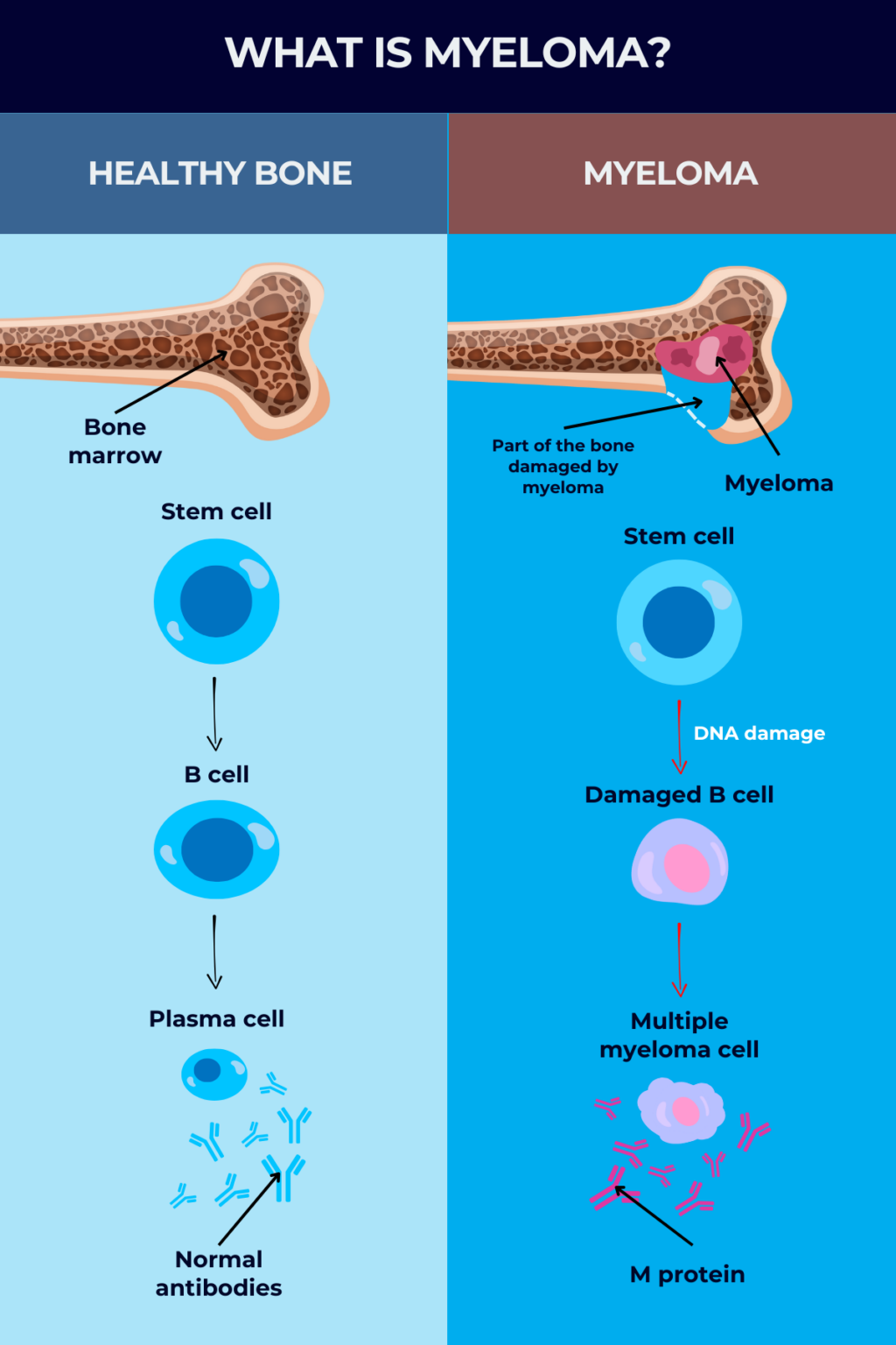 What is myeloma? | Rare Cancer News