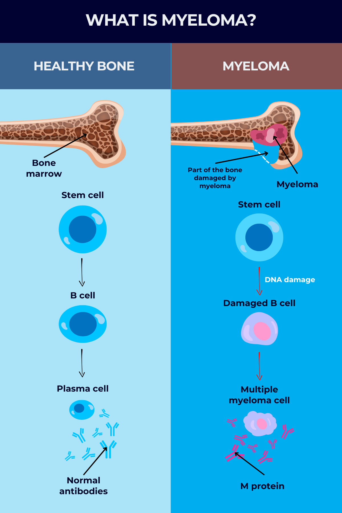 What is myeloma? | Rare Cancer News